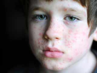 What is the Prognosis of Hives or Urticaria? | Snr