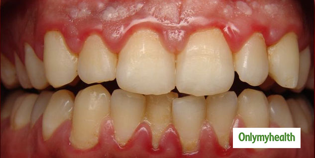 Pyria Teeth Problem Symptoms And Teeth Care In Hindi | मुंह स्‍वास्‍थ्‍य