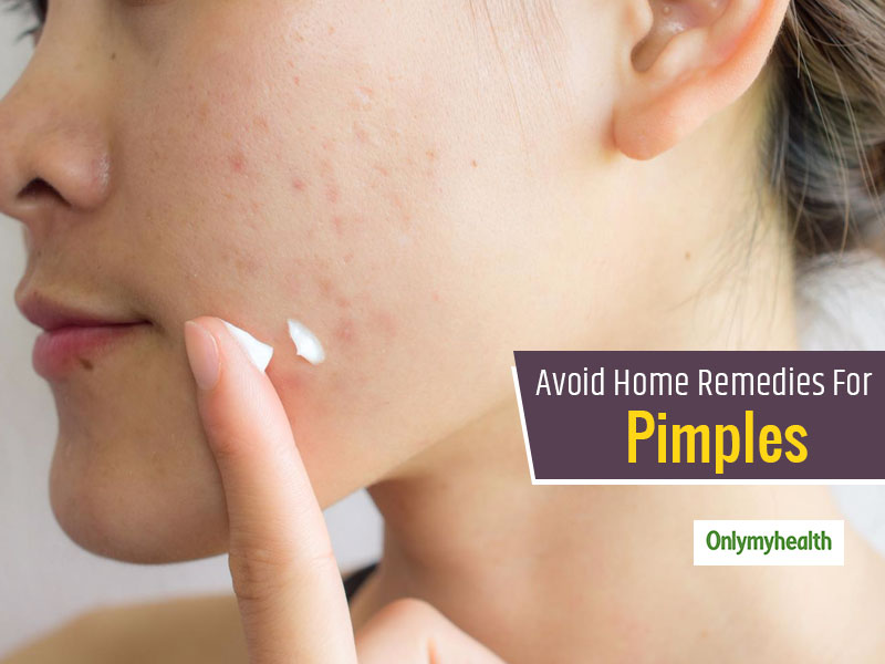 Avoid Any Random Home Remedy For Acne And Pimples Seek These Avoid Any Random Home Remedy For Acne And Pimples Seek These