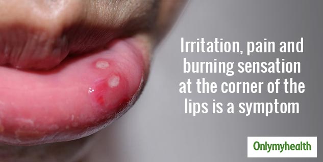 What Is Cheilosis? Everything You Need To Know About It