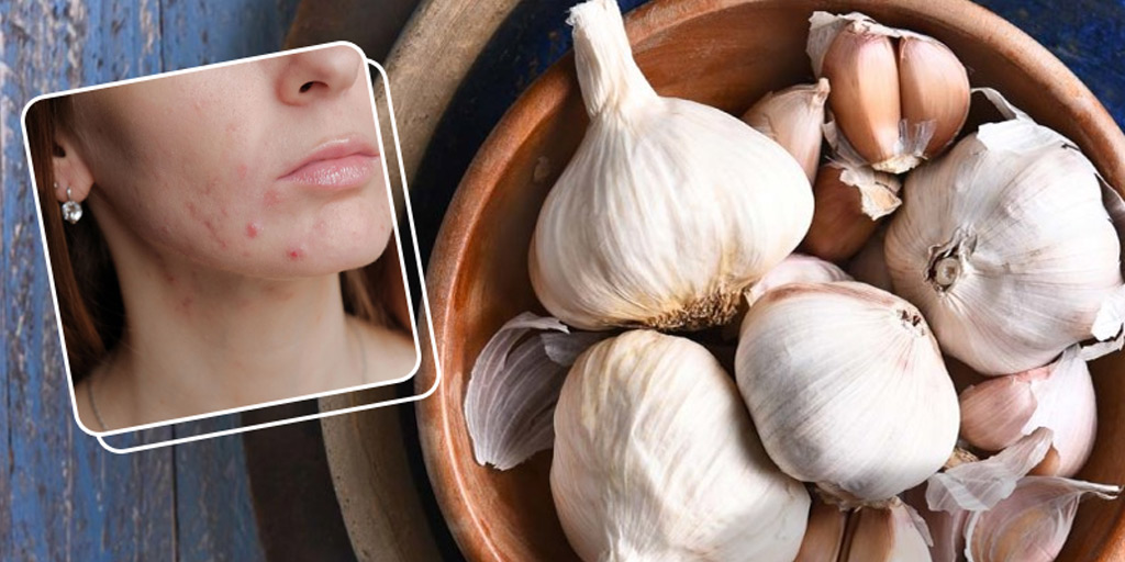5 Easy DIY With Garlic To Get Rid Of Acne | कील-मुंहासों को जड़ से ...