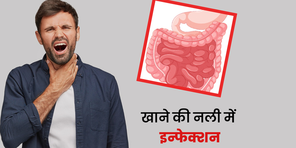 Infection In Food Pipe Or Esophagitis Causes Symptoms Prevention In ...