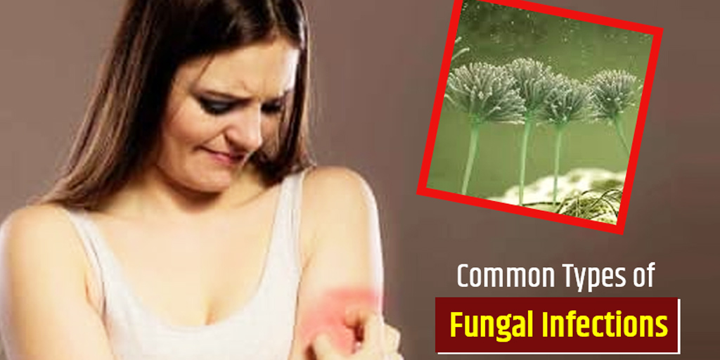5 Types Of Common Fungal Infections, Know Their Symptoms And Treatment ...