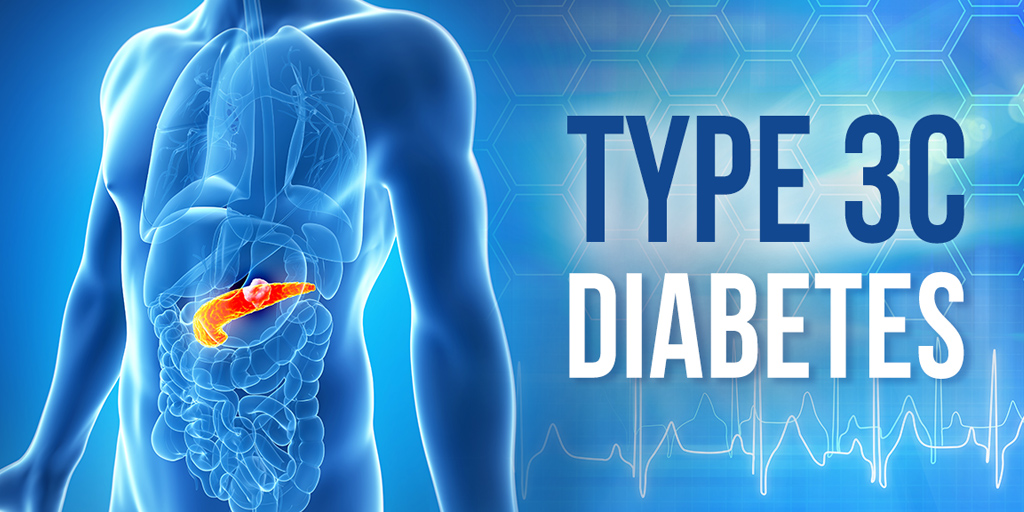 Type 3C Diabetes Symptoms Causes Prevention Tips | टाइप 3c डायबिटीज ...