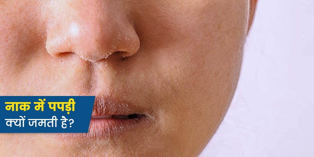 Causes Of Flakes On Nose During Winters Know Prevention Tips | सर्दियों ...