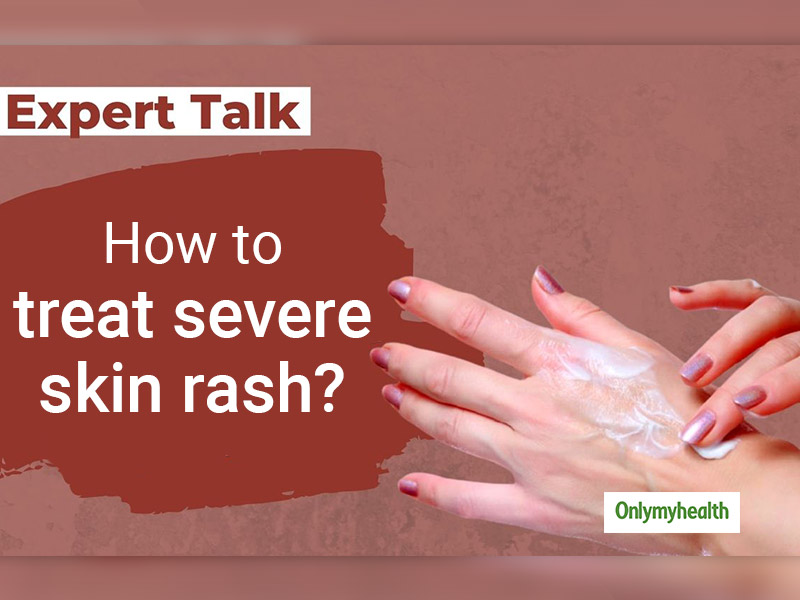 How To Treat Severe Bleeding Winter Rash? Know From An Expert