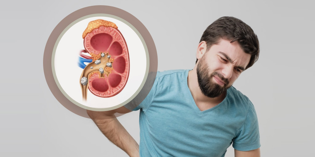 4 Kinds Of Kidney Stones You Need To Know About And Treatment Options ...