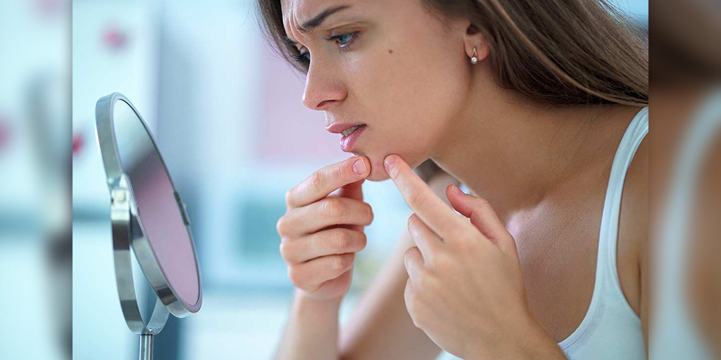 What Are Blind Pimples And DIY Remedies To Treat Them | Onlymyhealth