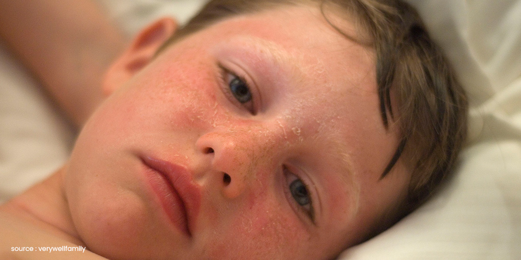 How To Prevent Skin Cancer In Kids | बच्चों को भी हो सकता है स्किन ...