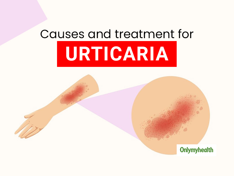 What Are The Causes And Treatment Of Urticaria Know From An Expert