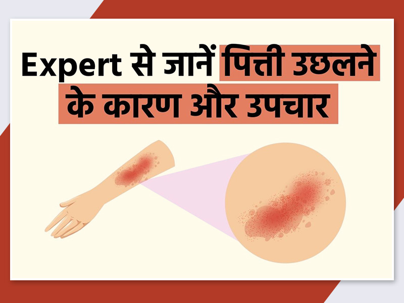 Urticaria Causes Know About Hives Treatment In Hindi। पित्ती उछलने के