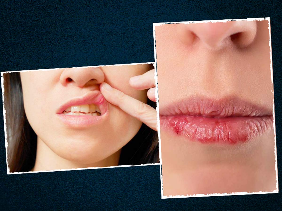 Lips Cancer Symptoms In Hindi | Lipstutorial.org