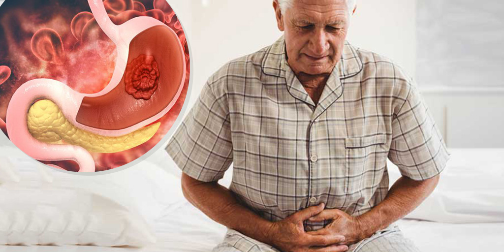 7 Myths About Stomach Cancer Debunked, Know Real Facts Behind It - 7 ...