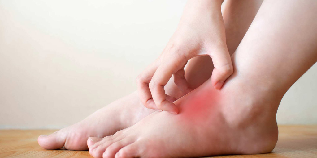 Flea Bite: Symptoms, Risks And Treatment From Expert - Flea Bite ...