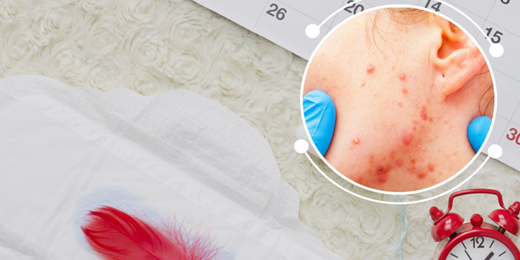 Everything You Need To Know About Periods And Acne Flare From A ...