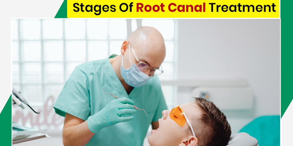 5 Stages Of Root Canal Treatment & The Correct Procedure | Onlymyhealth