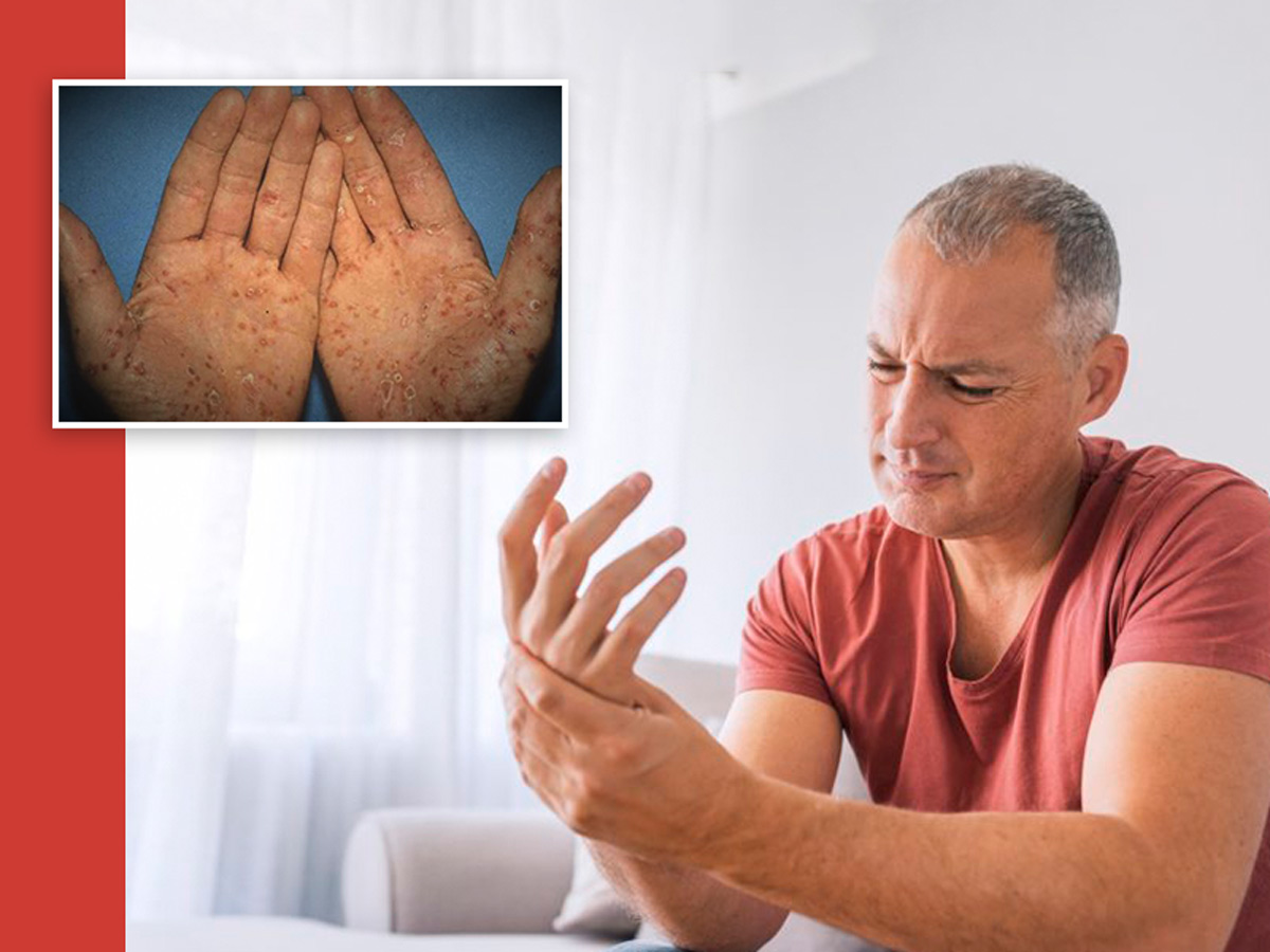 Reactive Arthritis Skin