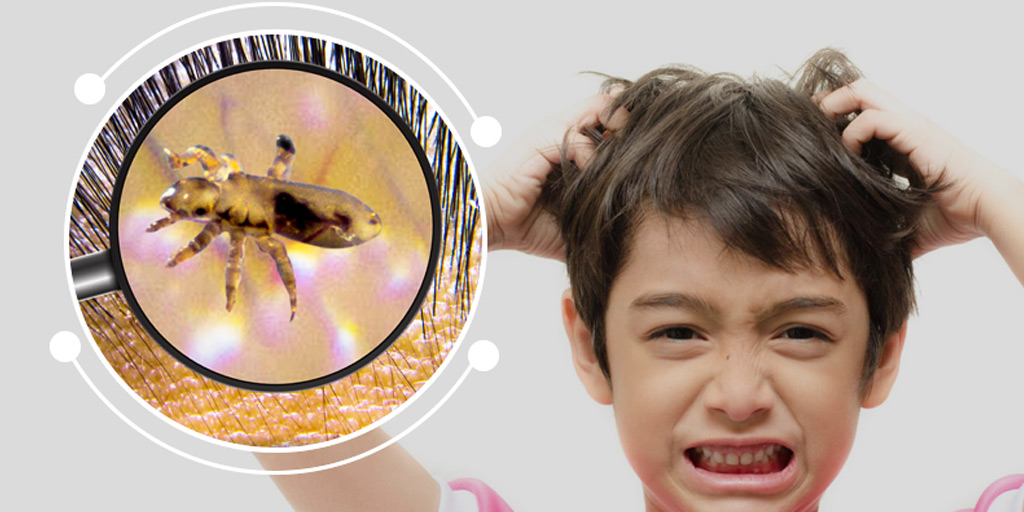 How To Differentiate Between Lice And Dandruff? Know About Symptoms And ...