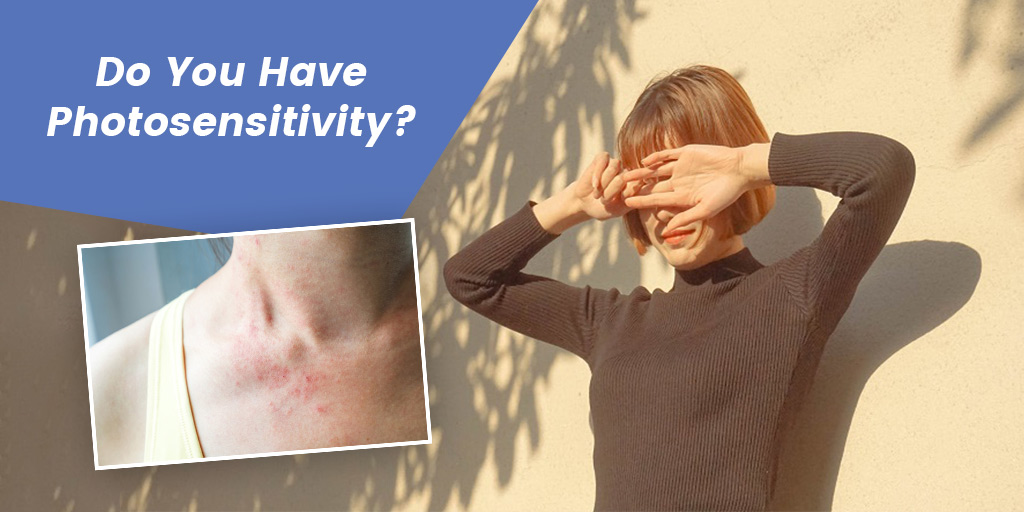 Photosensitivity| Symptoms Causes Types | Onlymyhealth