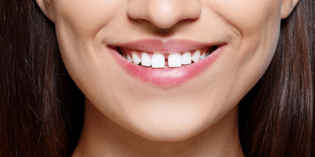 Diastema Gap Between Teeth Causes Treatment And Prevention What