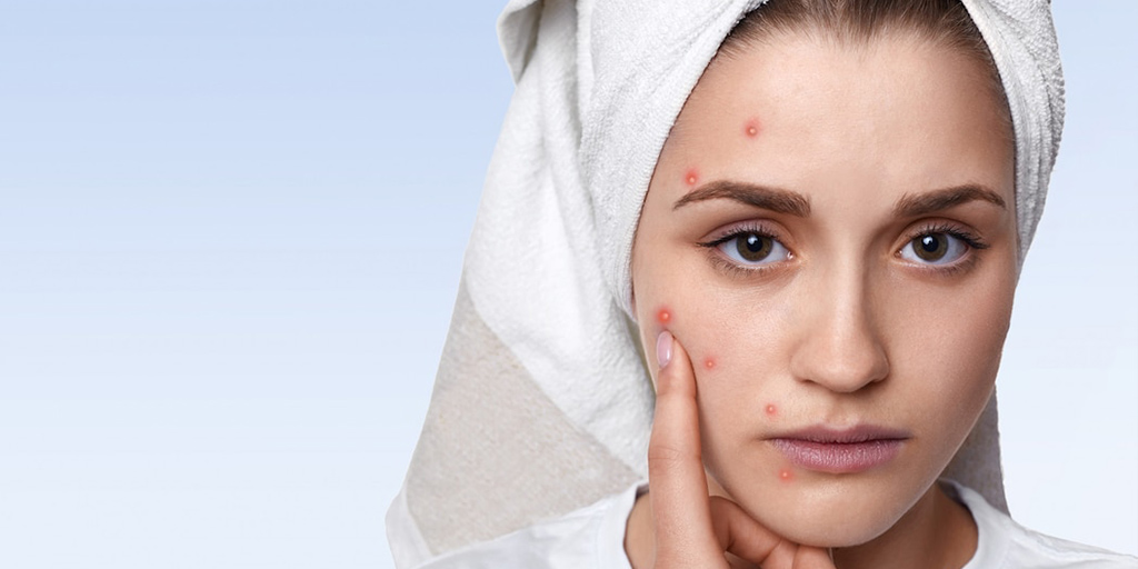 Home Remedies To Treat Red Sores On Face | Onlymyhealth