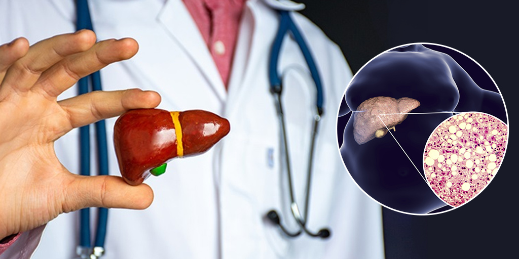 Non-Alcoholic Liver Disease: Symptoms And Treatments | Onlymyhealth