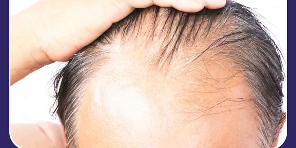 What is dht symptoms causes and treatment in hindi | डीएचटी (DHT) के ...