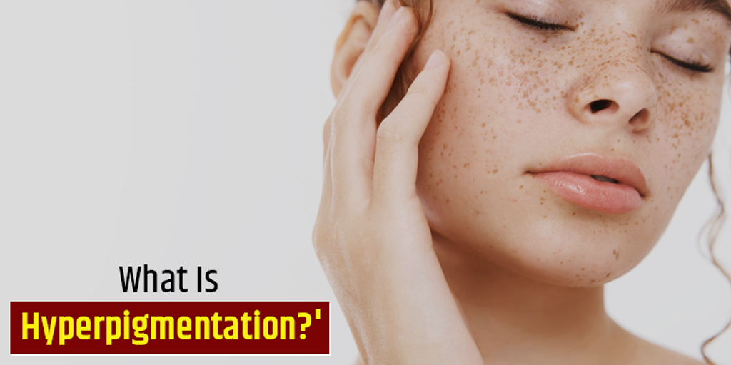 Hyperpigmentation Meaning, Causes, Treatment | Onlymyhealth