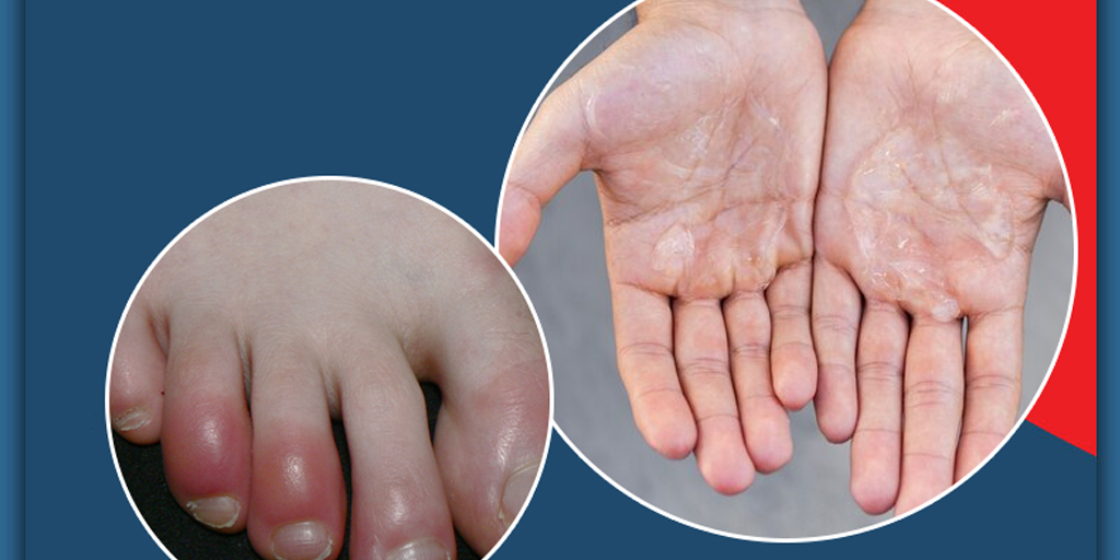Chilblains- Causes, Treatment and Home Remedies | Onlymyhealth