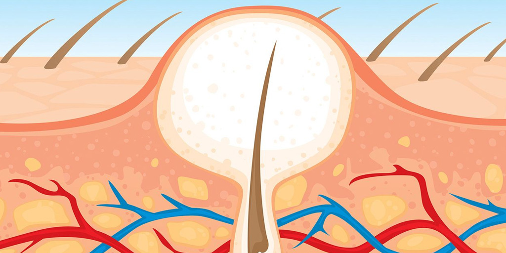 Follow These Simple Tricks To Eliminate And Prevent Ingrown Hair ...