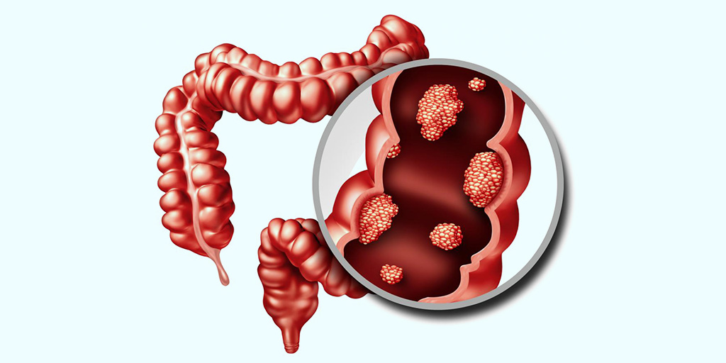 Role Of Fibre In Preventing Colon Cancer, Know From Expert | Onlymyhealth