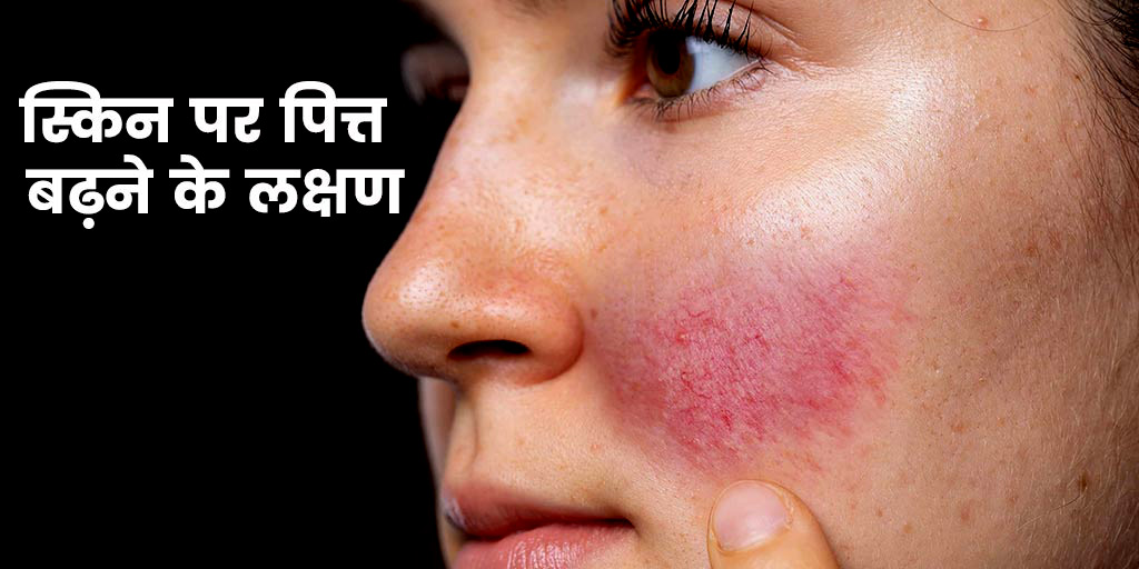 पित्त दोष के लक्षण और बढ़े हुए पित्त को संतुलित करने के उपाय | Pitta ...