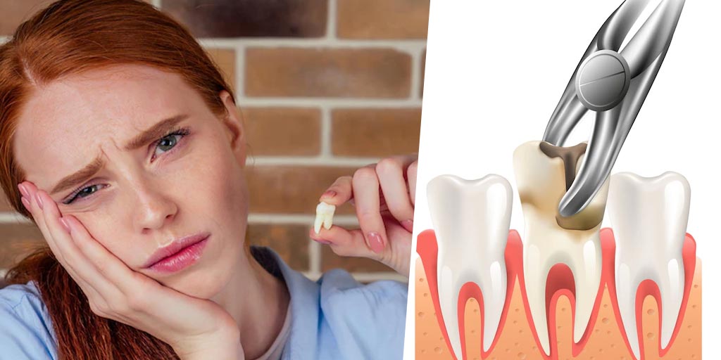 Impacted wisdom tooth removal and extraction recovery | Onlymyhealth