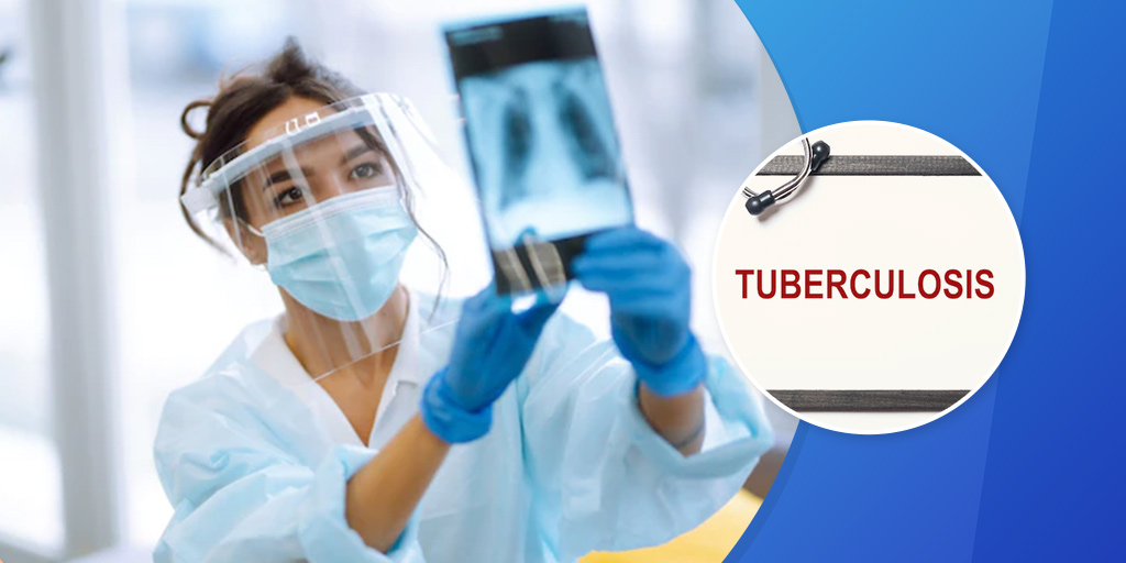 Tuberculosis Test Procedure and Types | Onlymyhealth