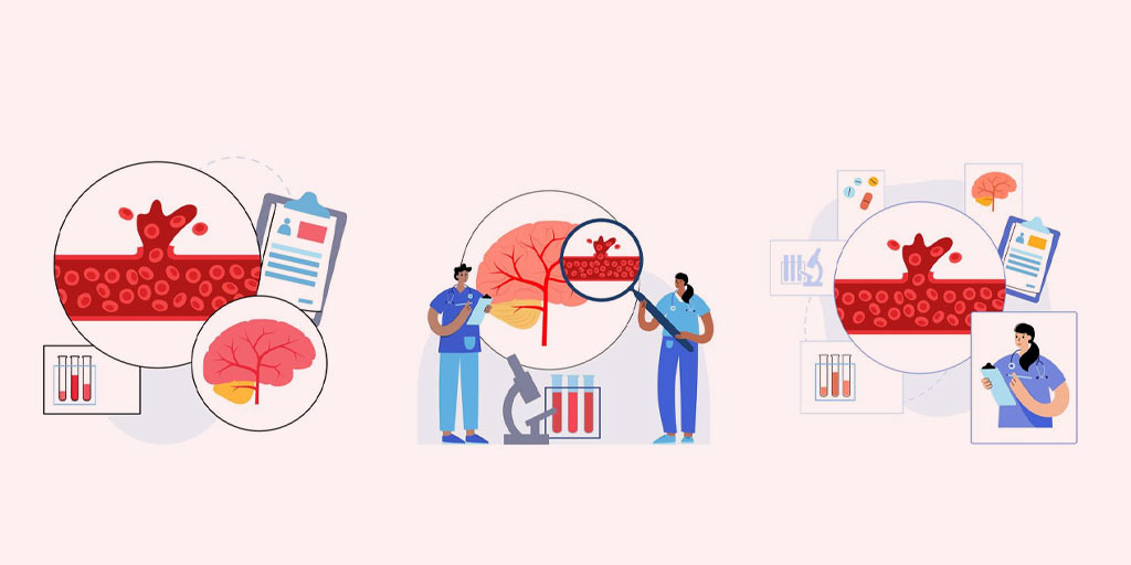 Brain Hemorrhage: Symptoms, Causes and Treatment | Onlymyhealth