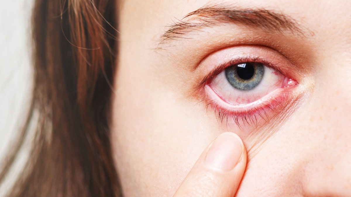 Sticky Eyes Or Dacryostenosis Causes And Treatment Jaw Health Care Blog