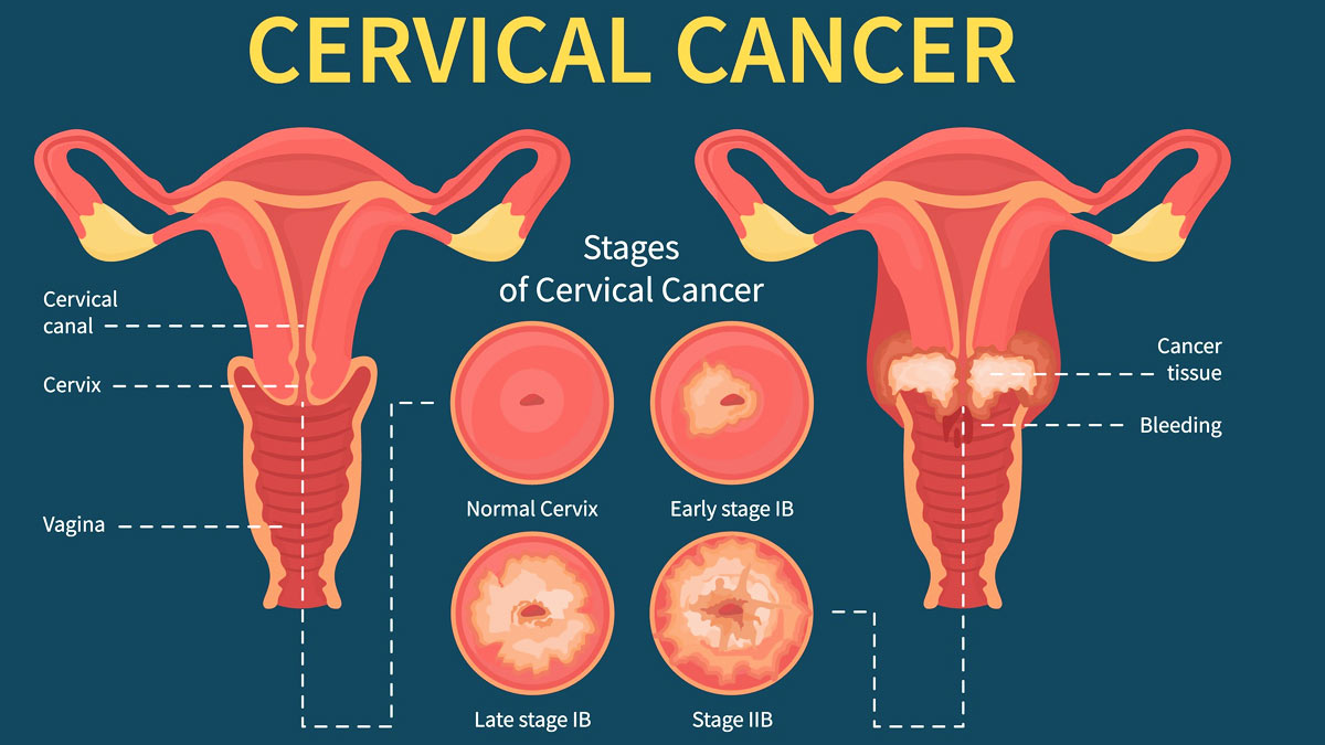 Gynaecological Cancer Awareness Month: 6 Different Types You Should Be ... Gynaecological Cancer Awareness Month: 6 Different Types You Should Be ...