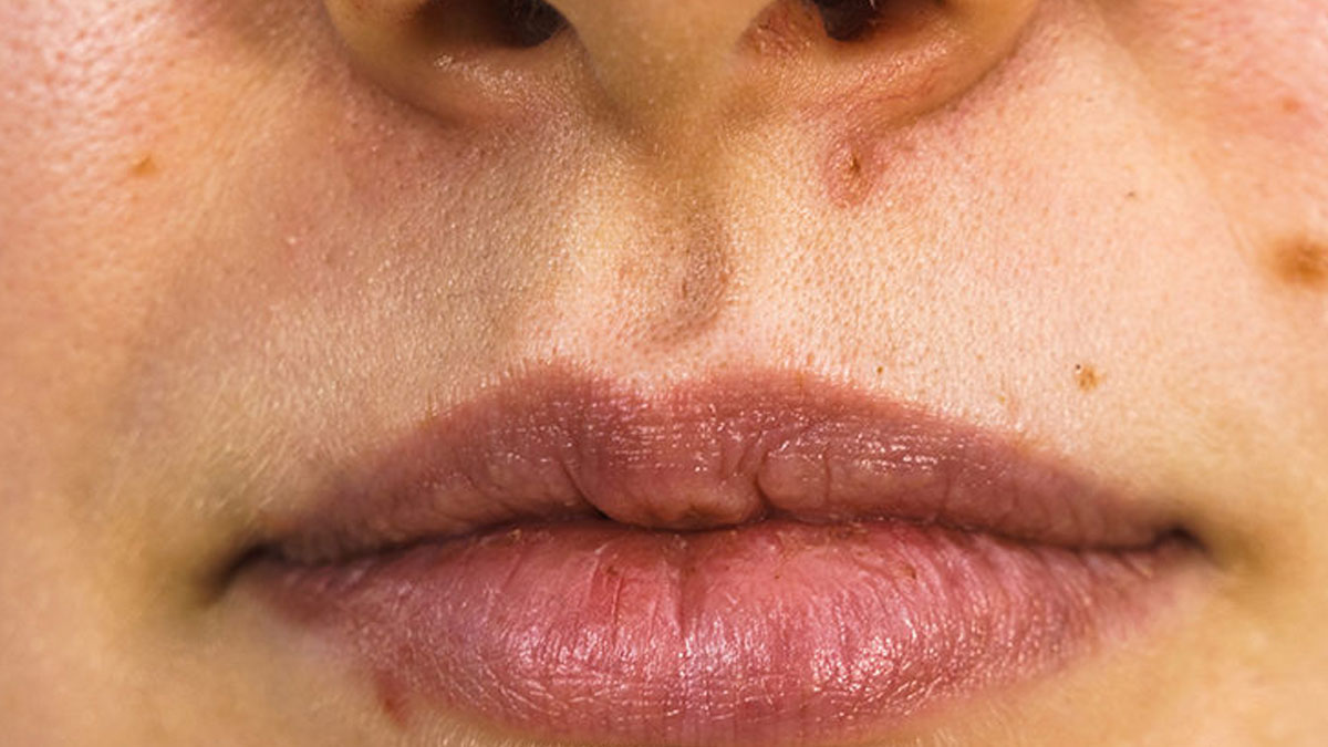 होंठ के ऊपर फुंसी के घरेलू उपाय | Home Remedies For Pimple Above Lips ...
