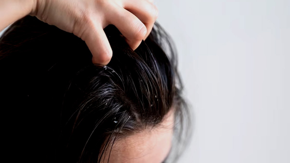 5 Reasons Why You Are Susceptible To Dandruff | OnlyMyHealth 5 Reasons Why You Are Susceptible To Dandruff | OnlyMyHealth