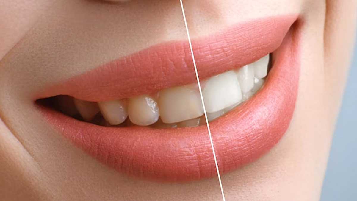 Causes Of Teeth Yellowing And Easy Ways To Whiten Teeth At Home