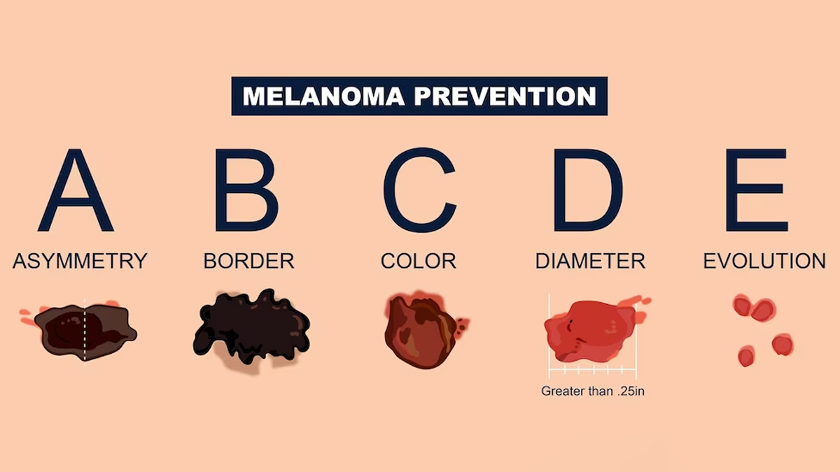 Abnormal Mole Or Skin Growth Experts Explains Detection And Types Of Melanoma Onlymyhealth