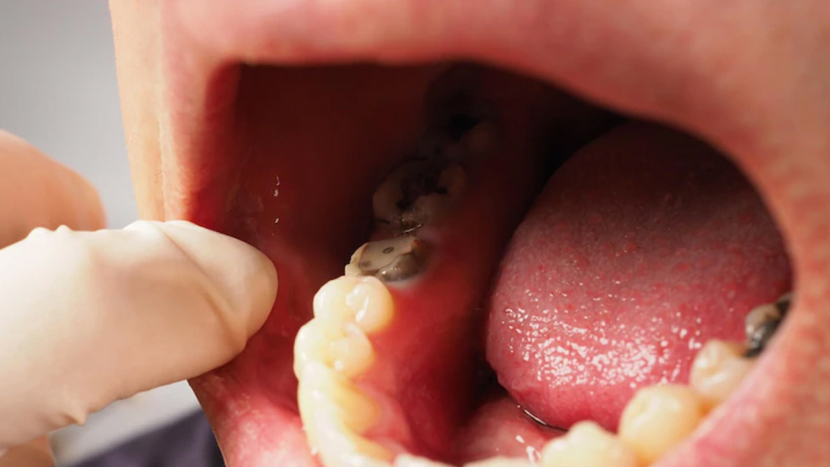Healthy Socket After Extraction Healthy Socket After Extraction
