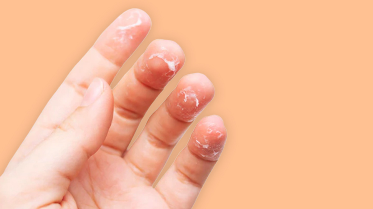 Finger Skin Peeling Finger Skin Peeling