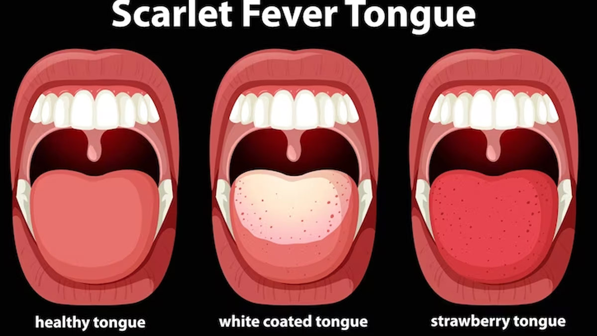 Scarlet Fever Common Signs Causes Risk Factors And More Onlymyhealth