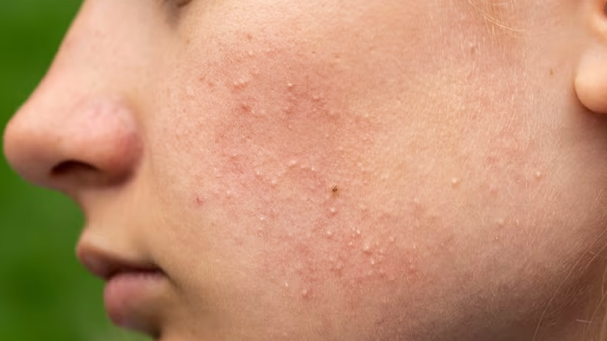 What Is Milia And How To Get Rid Of It OnlyMyHealth What Is Milia And How To Get Rid Of It OnlyMyHealth