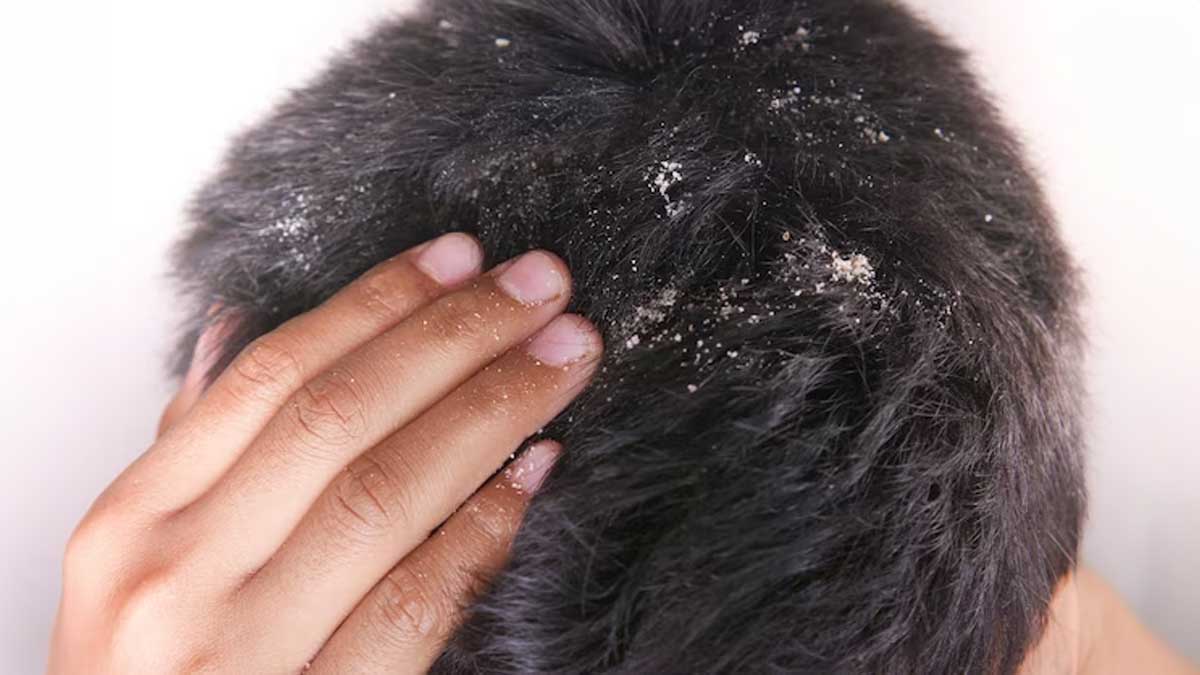 Dry Scalp Vs Dandruff Experts Explains How To Differentiate Between