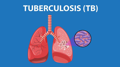 Tuberculosis Lungs Vs Healthy Lungs