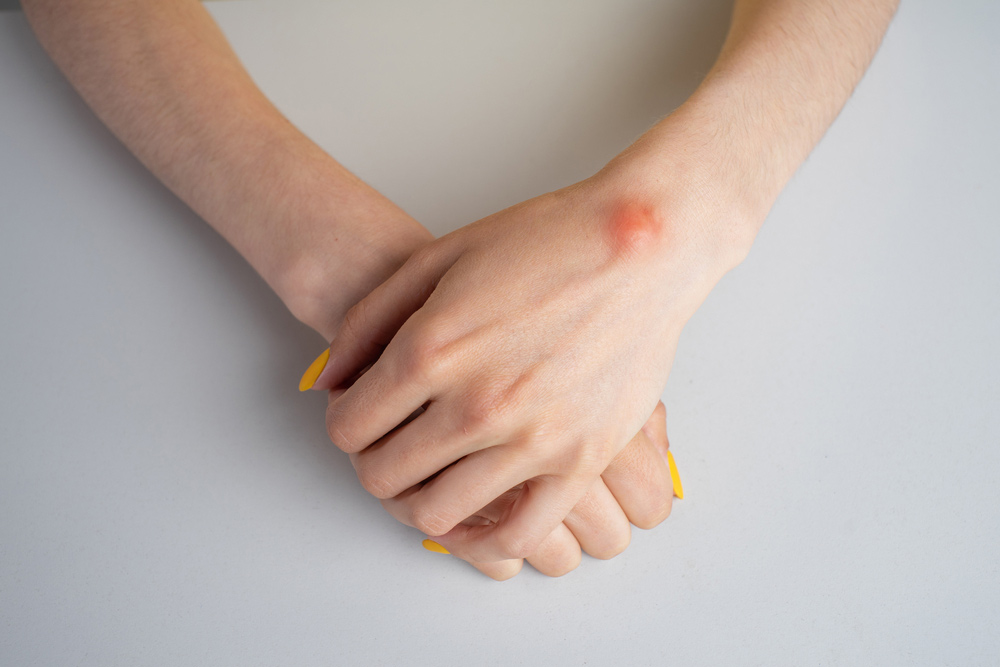 How To Know If The Fatty Skin Lump Is Lipoma Or Cancer OnlyMyHealth How To Know If The Fatty Skin Lump Is Lipoma Or Cancer OnlyMyHealth