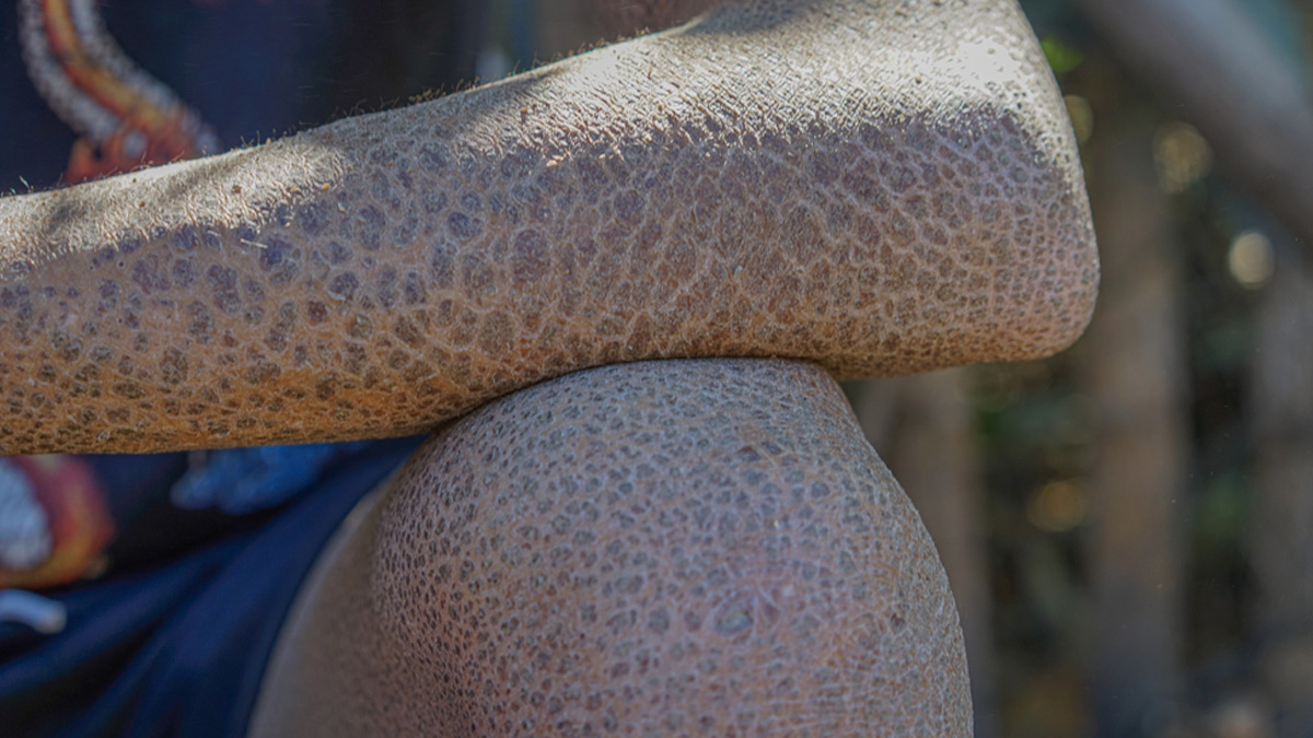 Understanding Ichthyosis Expert Explains This Genetic Skin Disorder And Its Types And