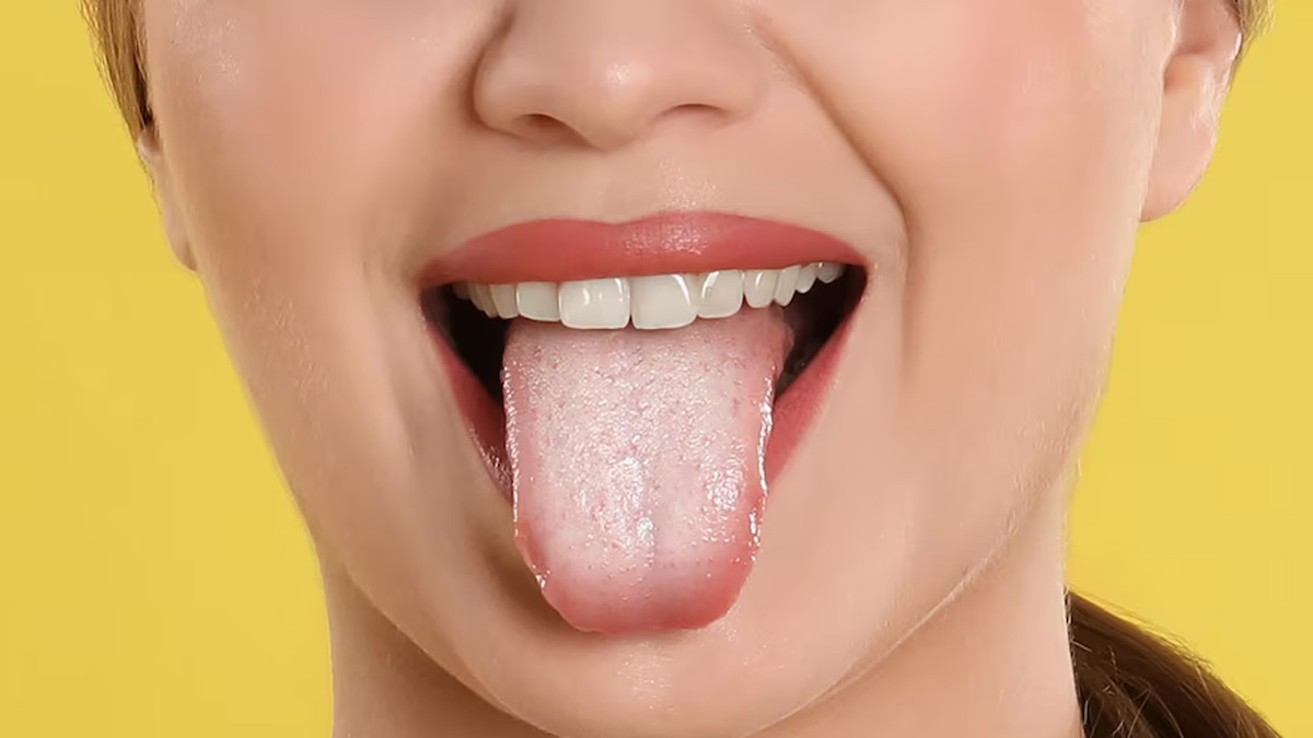 Dealing With Oral Thrush Try These Home Remedies To Combat It Onlymyhealth
